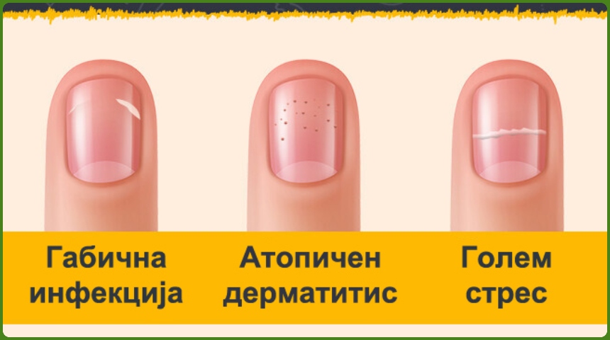 Што може да значат линиите на вашите нокти? | Мотика